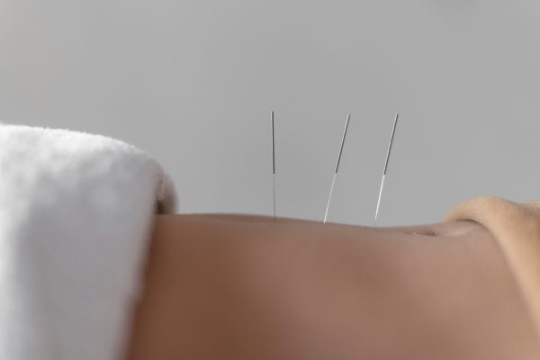 Unlocking L14 Pressure Point: Acupuncture Benefits | Acubody